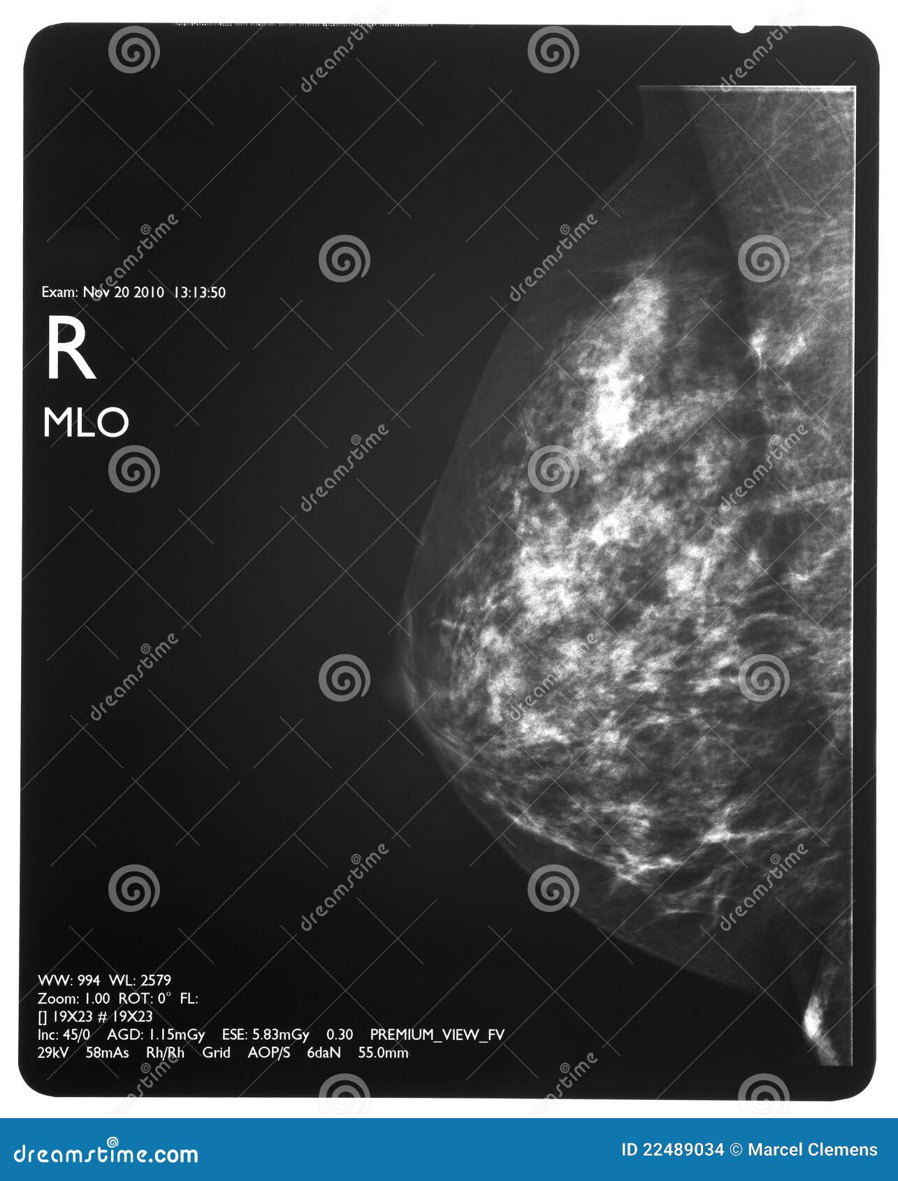 Healthy Breast Scan X-ray Plate. Stock Photo - Image of negative ...