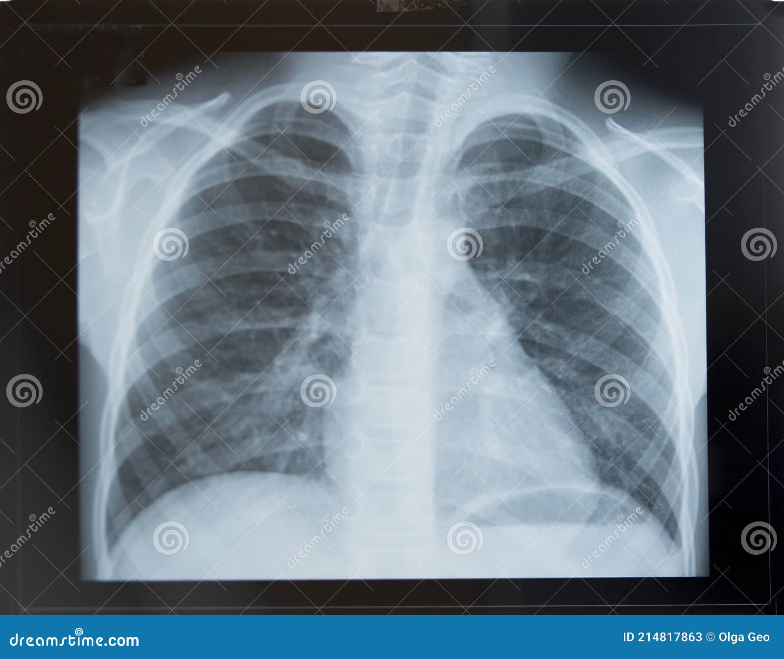 Healthy Child Chest X-ray:the Ribs And Lungs Without Damage Stock Image ...