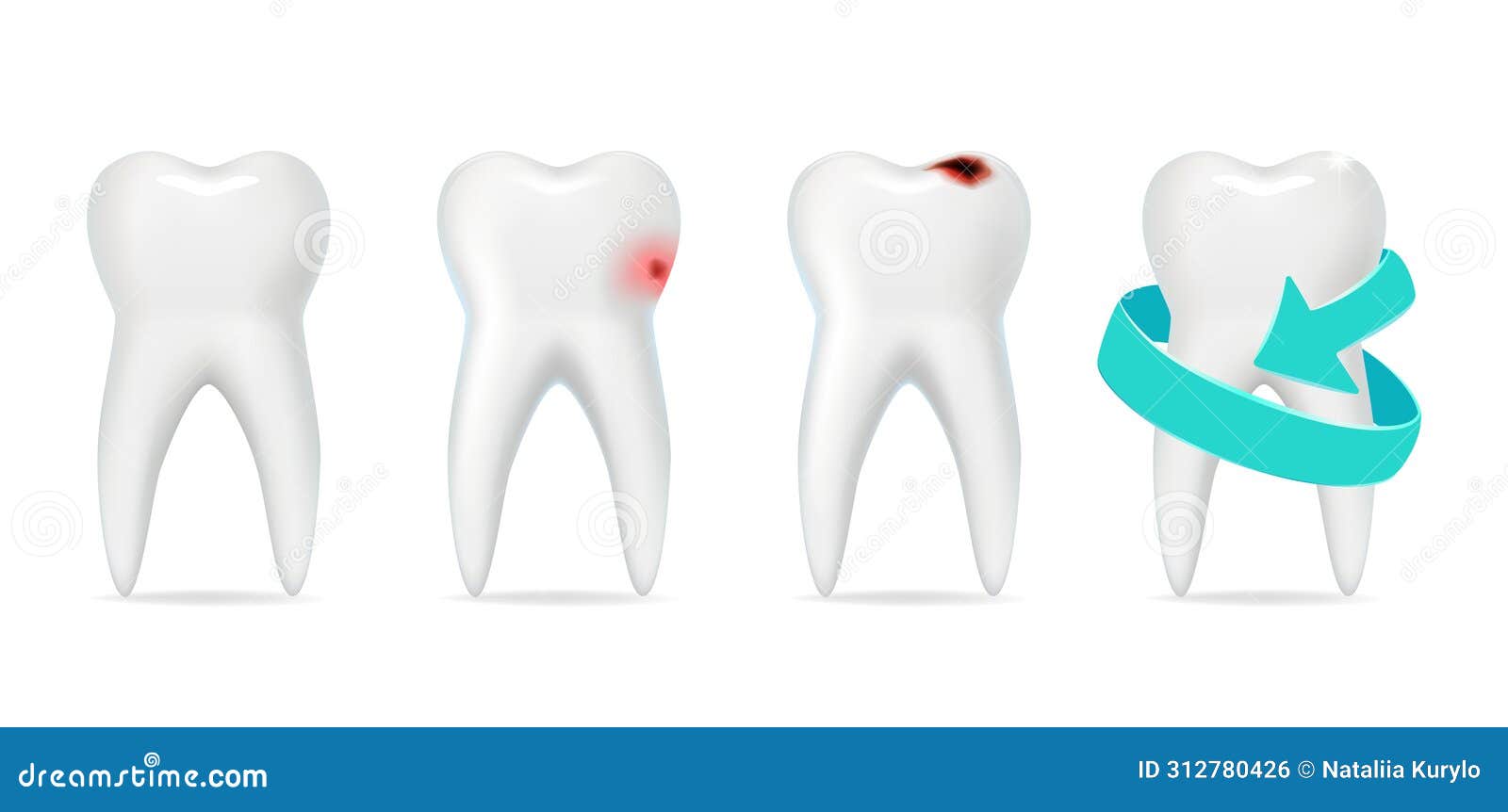 Healthy and Diseased Tooth with Caries, Tooth Protection. Stock Vector ...