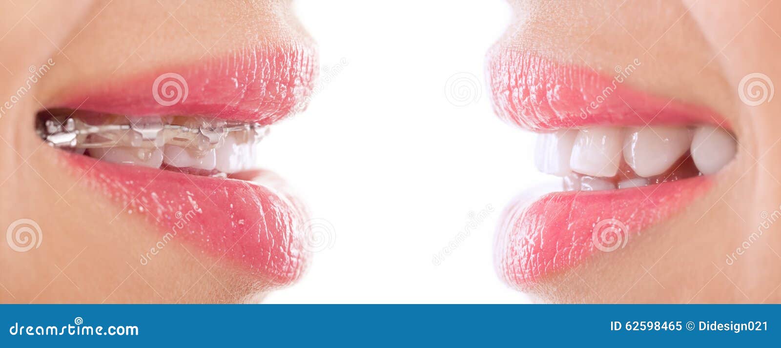 Healthy Happy Smile with Braces Stock Image - Image of dentist, mouth ...