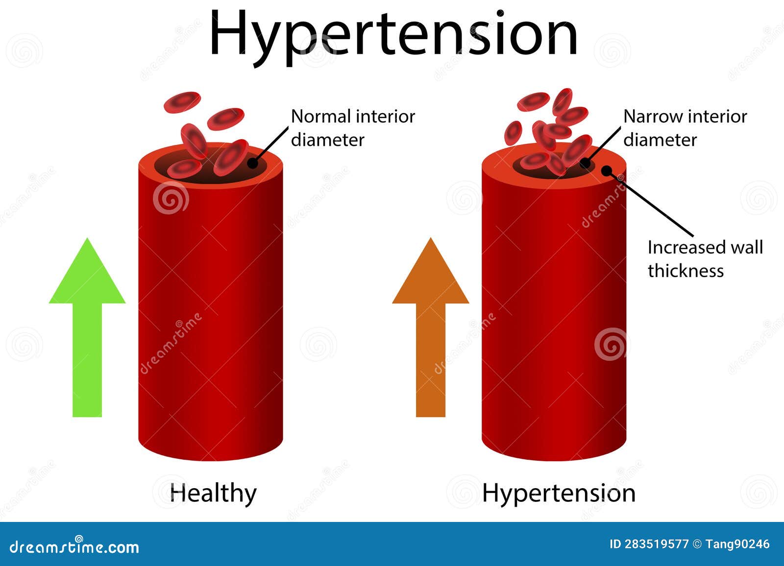 Healthy And Hypertensive Blood Vessel Stock Photo | CartoonDealer.com ...