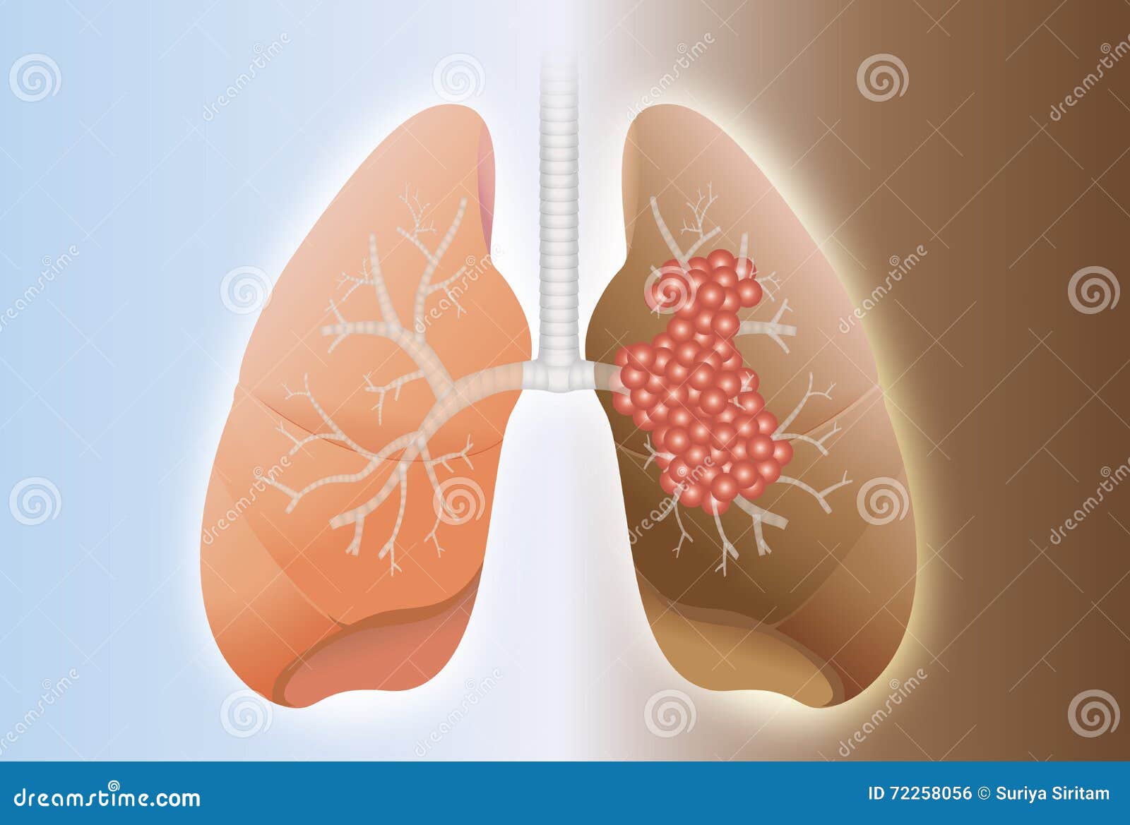 Bad Healthy Of Lung And Good Healthy Of Lung, Character Vector ...