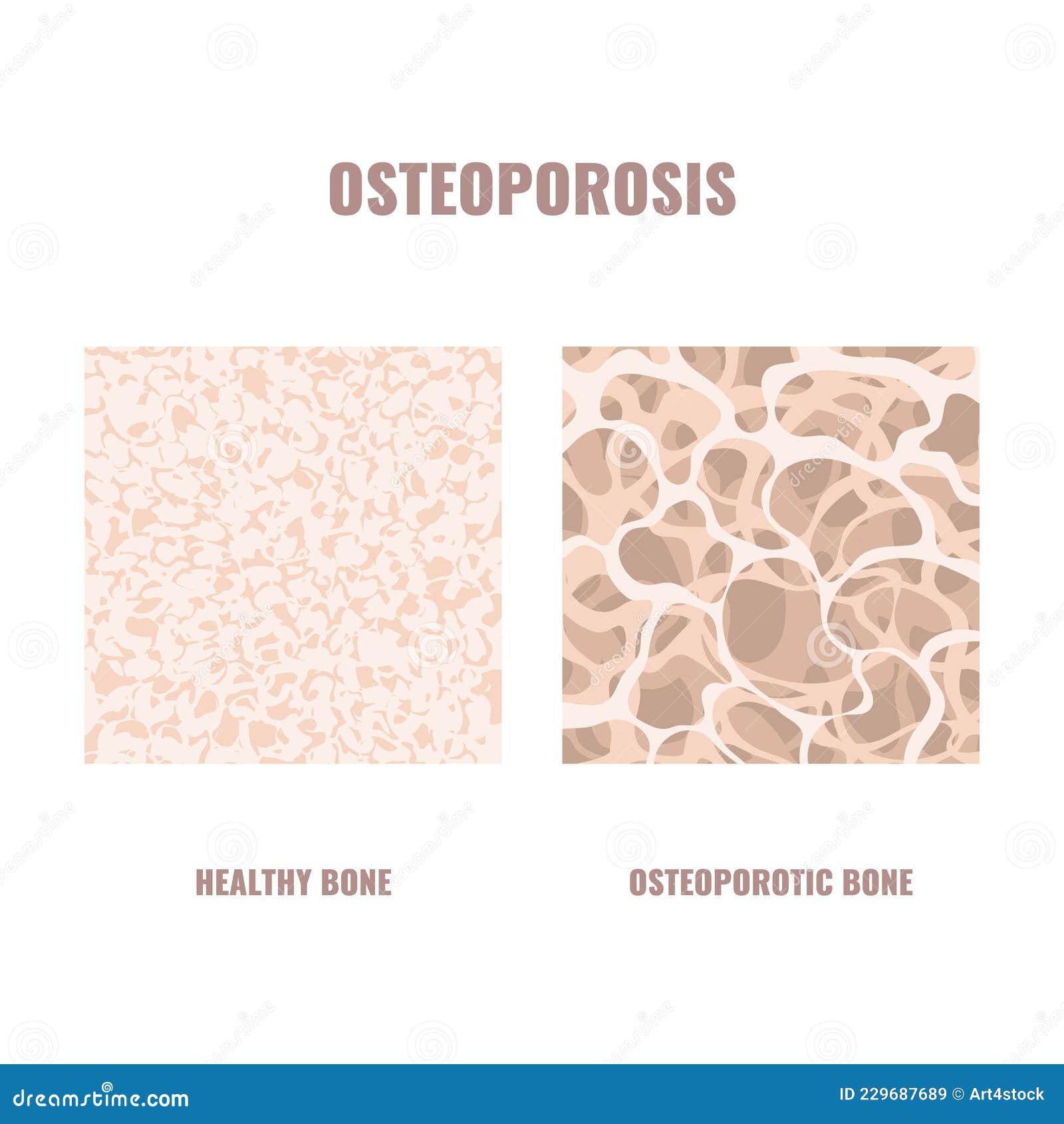 Osteoporosis Bone Density Loss Disease Medical Infographics Stock ...