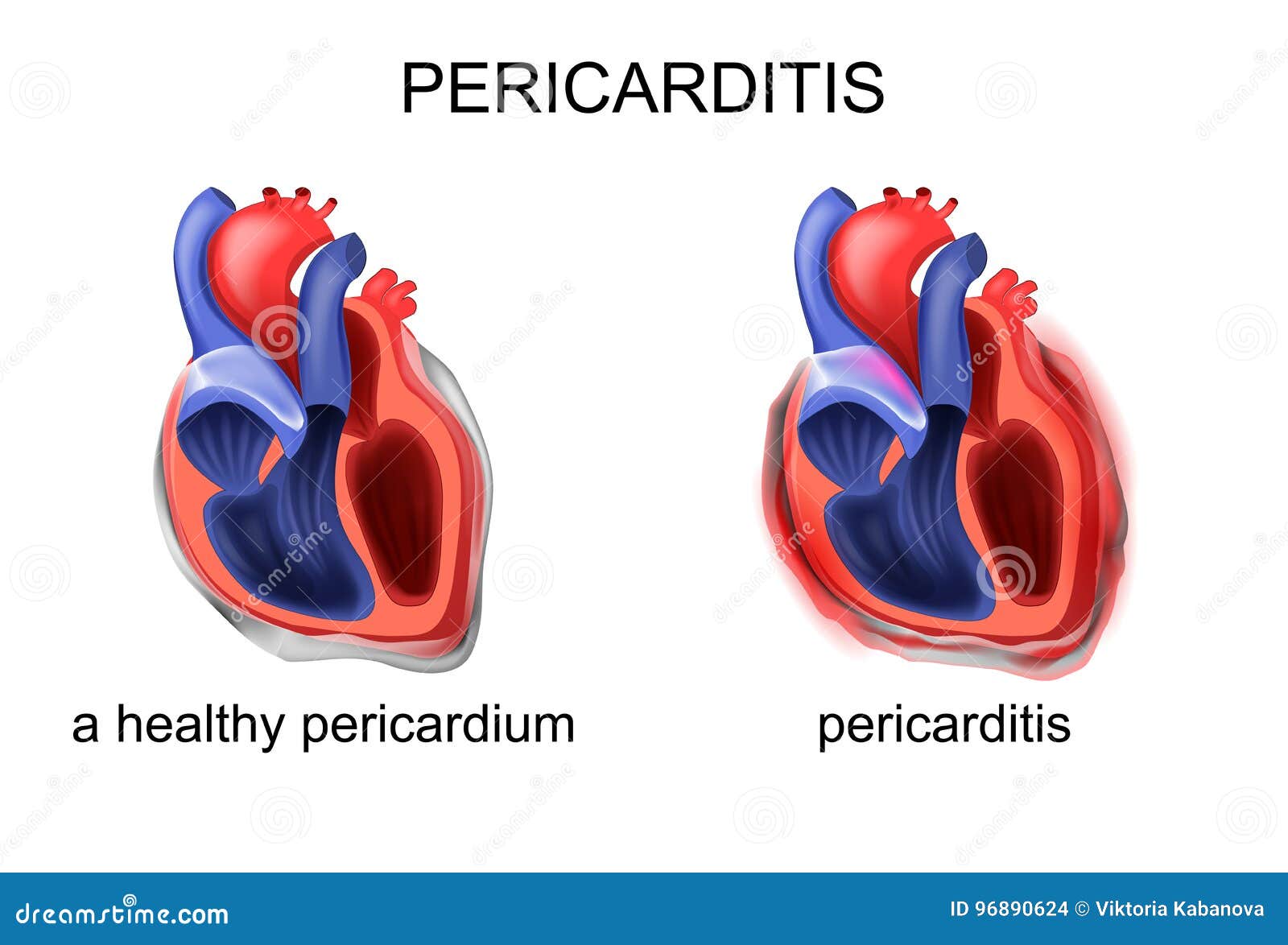 A Healthy Pericardium, Pericarditis Stock Vector - Illustration of ...