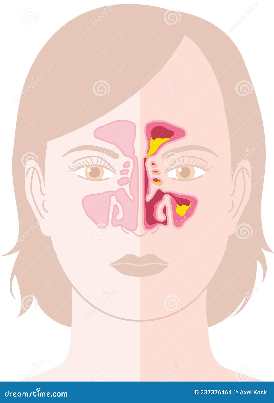 Sinusitis Medical Treatment. Healthy And Inflammation Sinus. Nasal ...