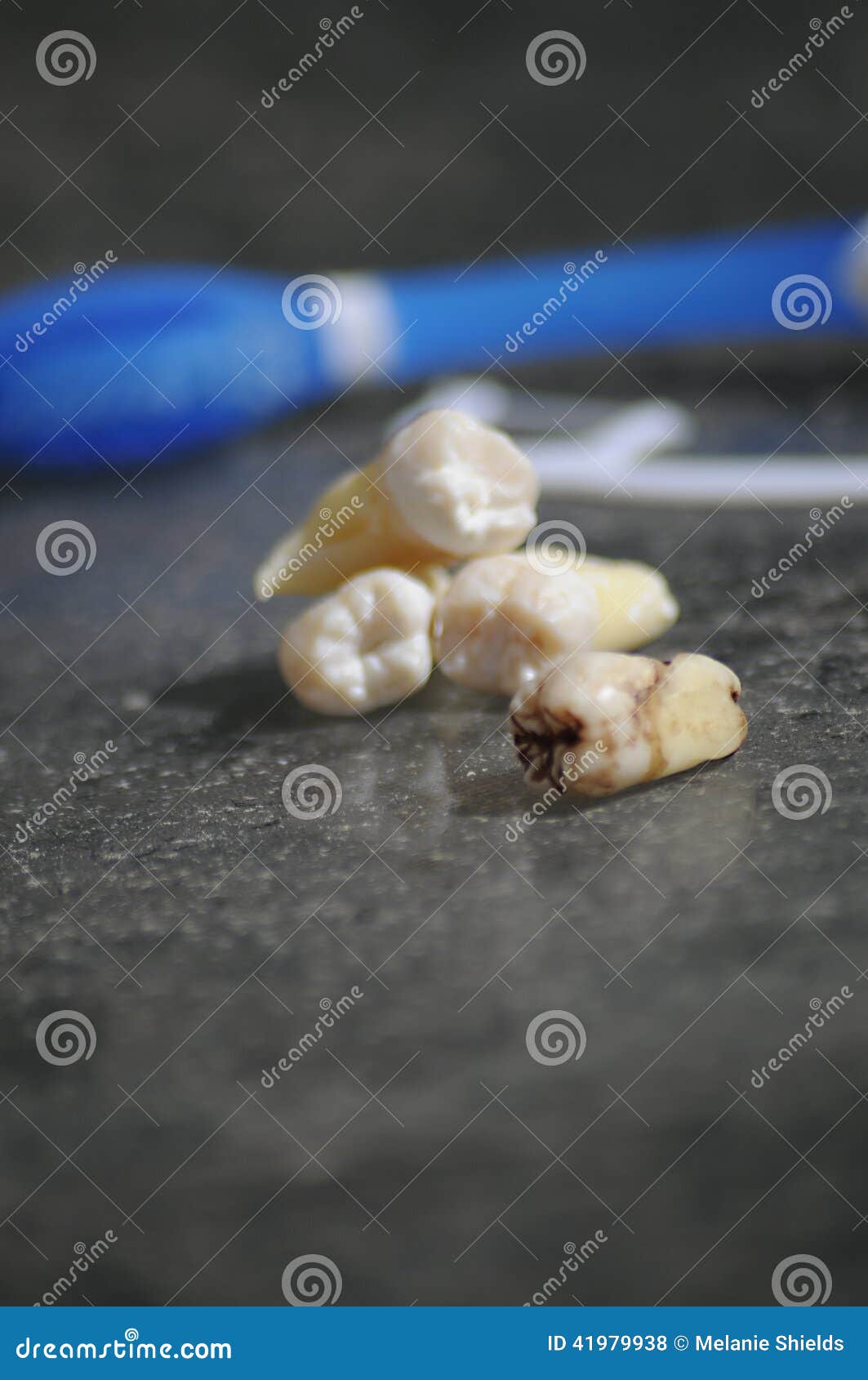 Cavity On Extracted Teeth Stock Photo | CartoonDealer.com #84086436