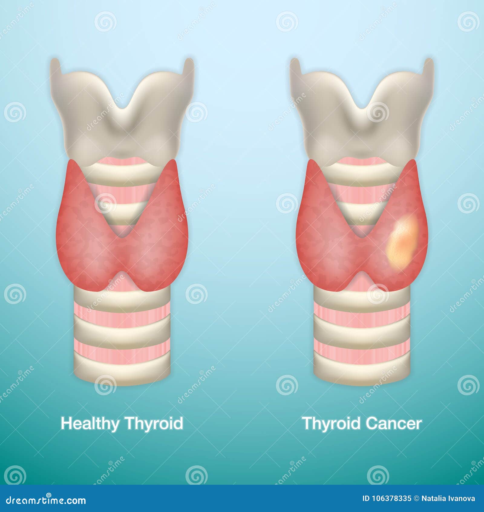 Healthy Thyroid Gland And Hyperthyroidism, Cartoon Characters. Medical ...