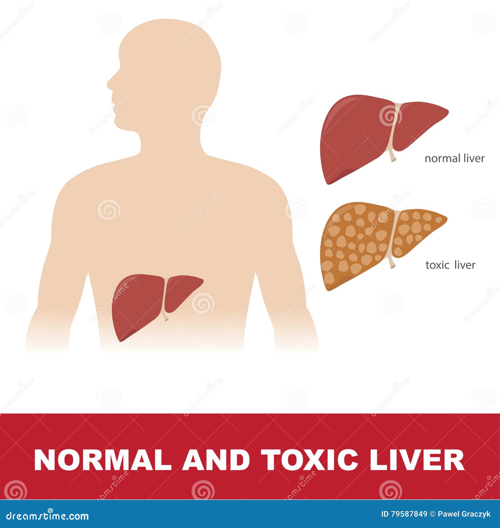 Healthy and toxic liver stock vector. Illustration of education - 79587849