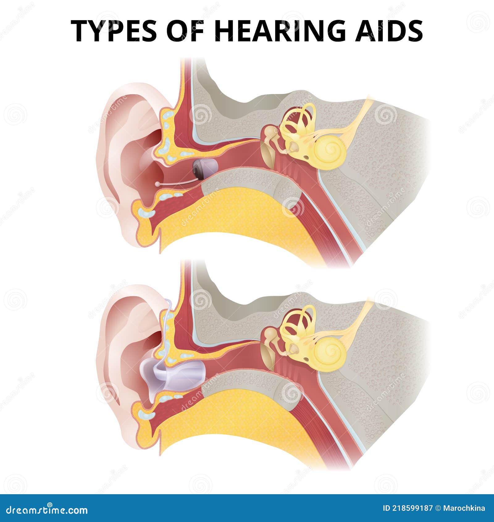 Types Of Hearing Aids For The Hearing Impaired And The Deaf.Different ...