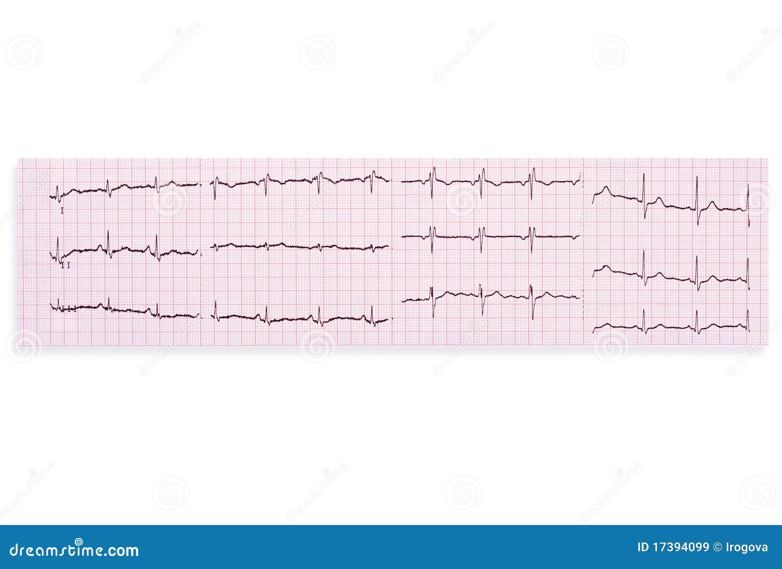 Heart Analysis, Electrocardiogram Graph (ECG) Stock Photography ...