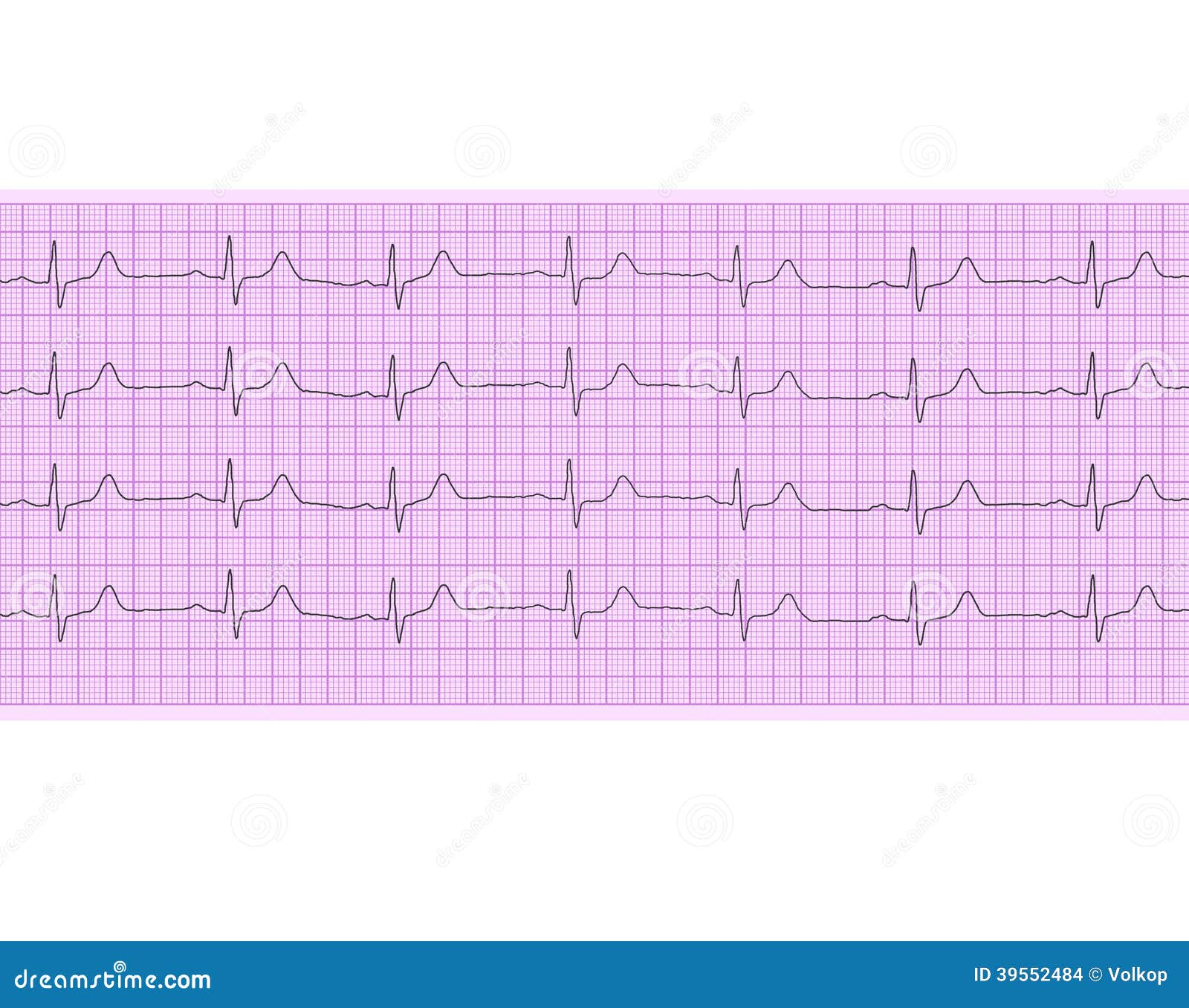 Electrocardiogram, Ecg, Graph, Pulse Tracing Royalty-Free Stock ...