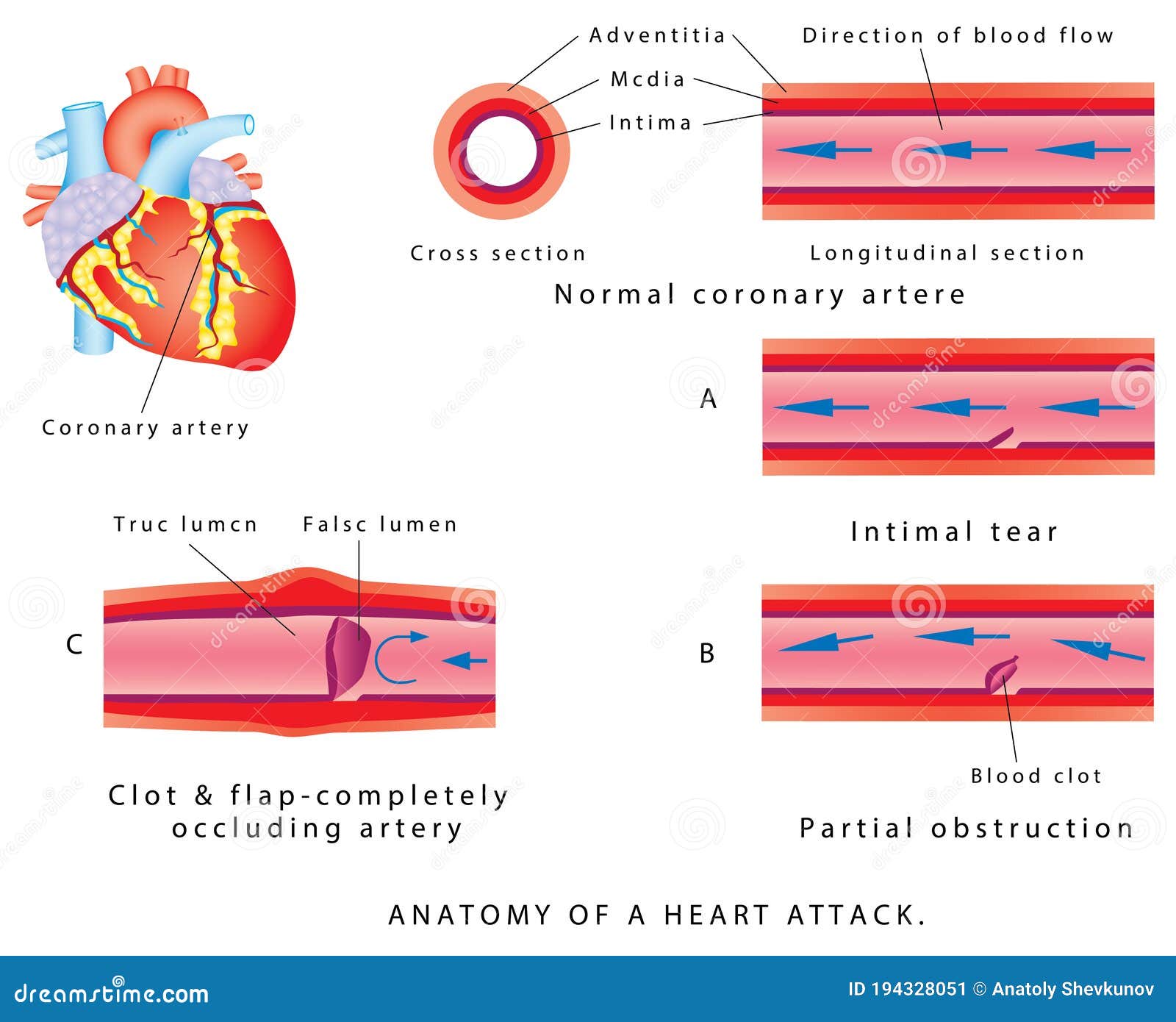 Heart attack stock vector. Illustration of healthy, infarction - 194328051