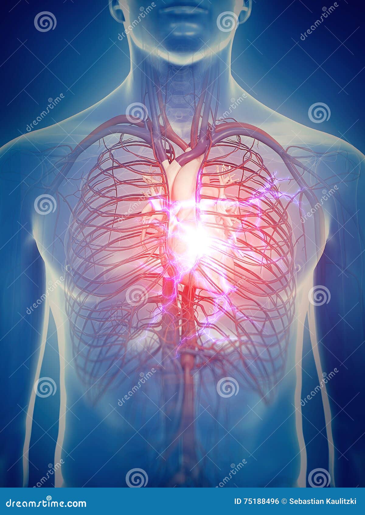 A heart attack stock illustration. Illustration of anatomical - 75188496