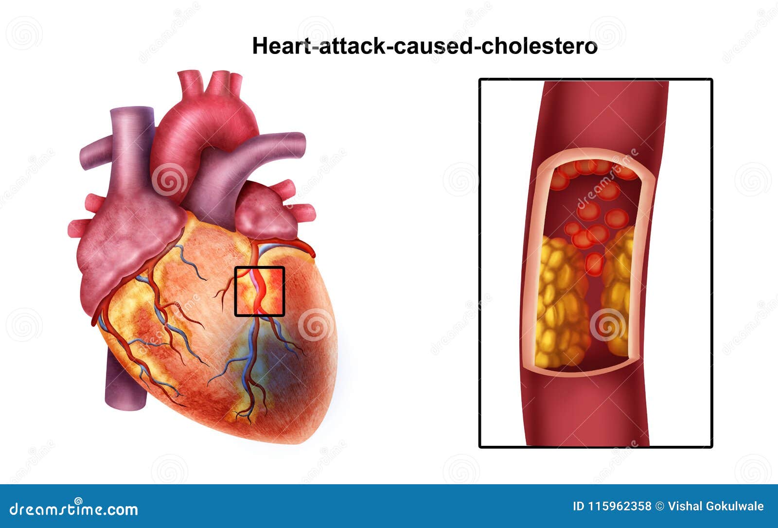 Heart-attack stock illustration. Illustration of cardiology - 115962358
