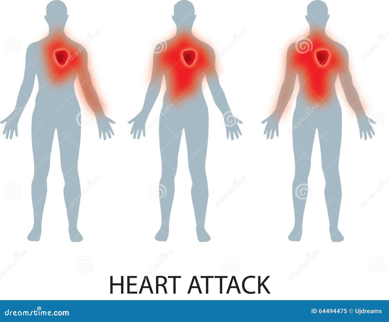 Heart attack stock illustration. Illustration of patient - 64494475