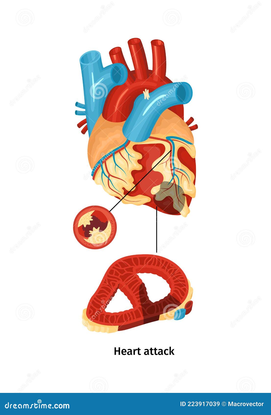 Heart Attack Poster stock vector. Illustration of clipart - 223917039