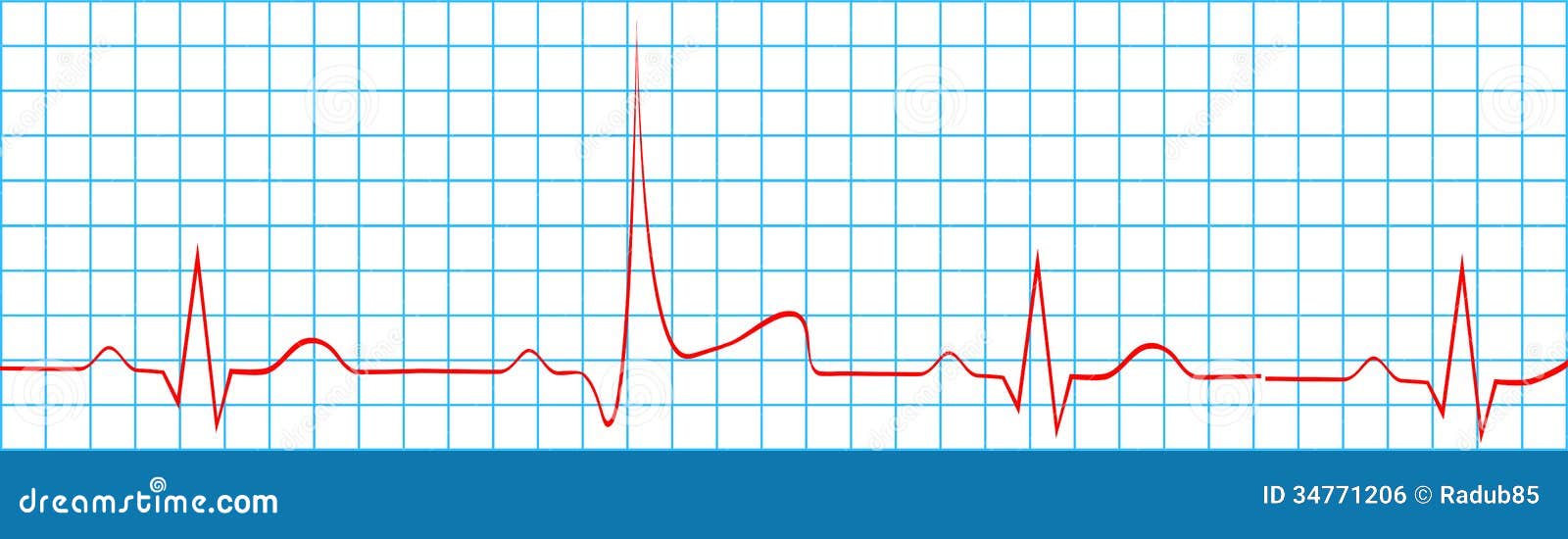 Heart Attack Stroke On Electrocardiogram Record Royalty Free Stock ...