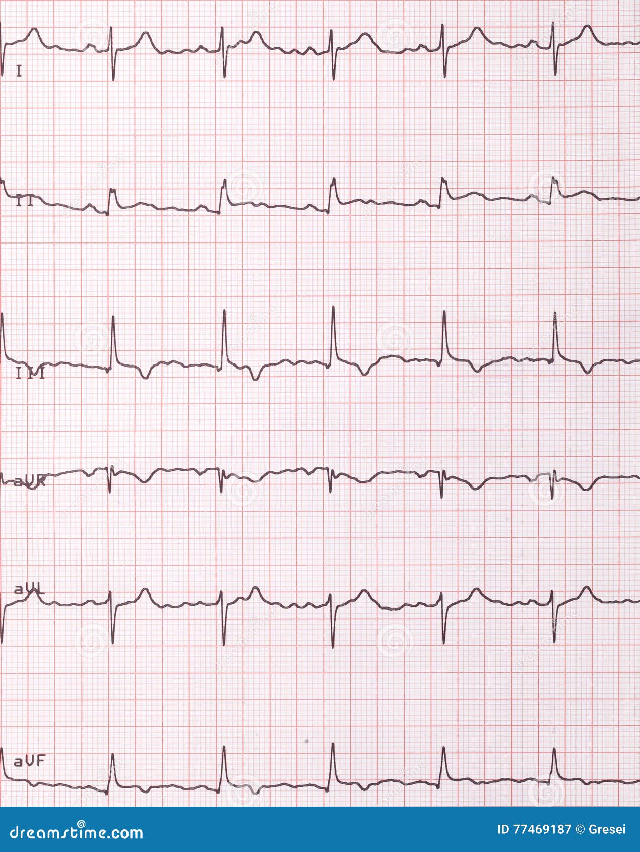 Heart beats cardiogram stock image. Image of graph, medicine - 77469187