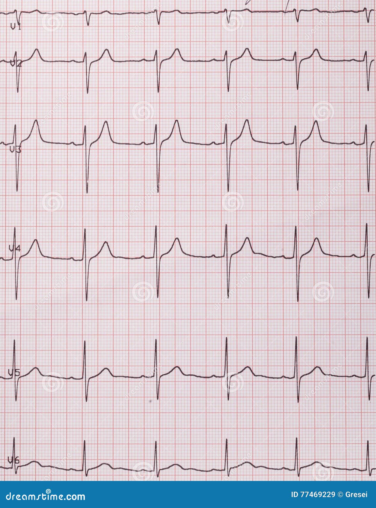 Heart beats cardiogram stock image. Image of wave, medicine - 77469229
