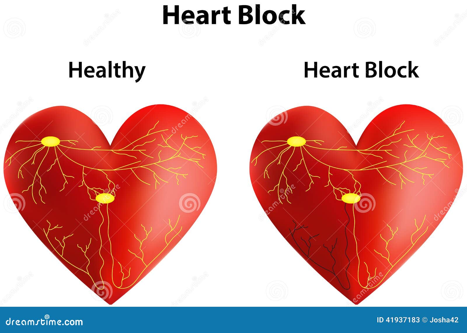 Atrioventricular Block. Violation Of The Electrical Signal In The Heart ...