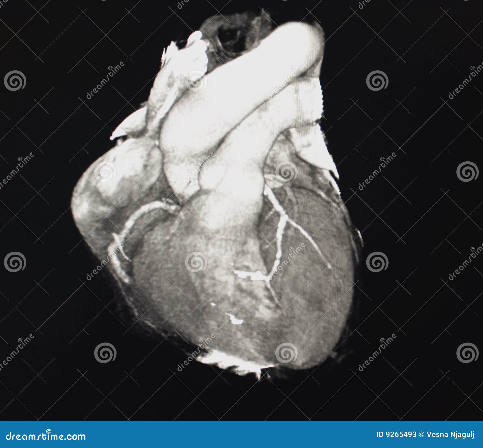Heart Computed Tomography stock image. Image of skeleton - 9265493