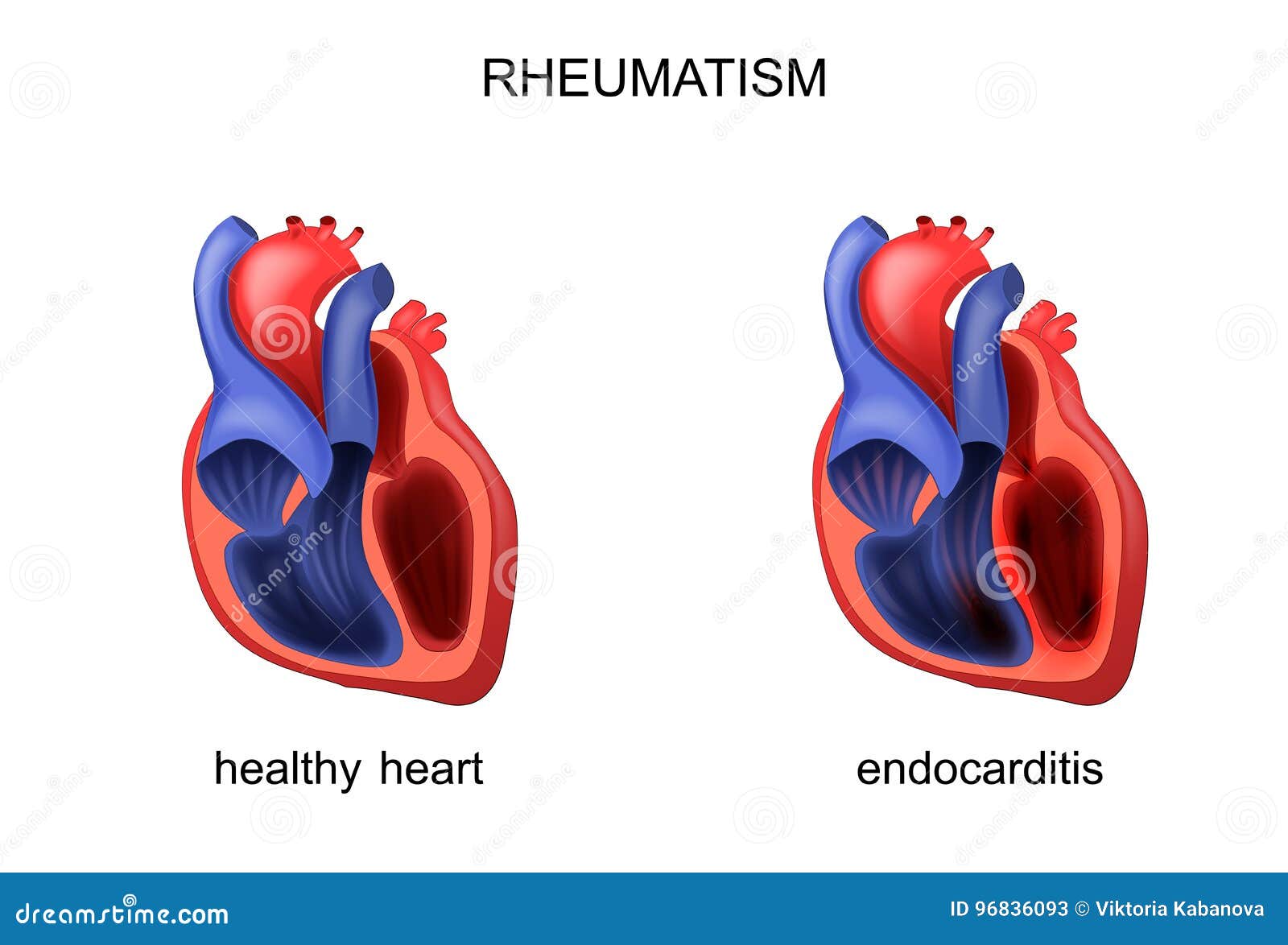 Heart Healthy and Diseased Endocarditis Stock Vector - Illustration of ...