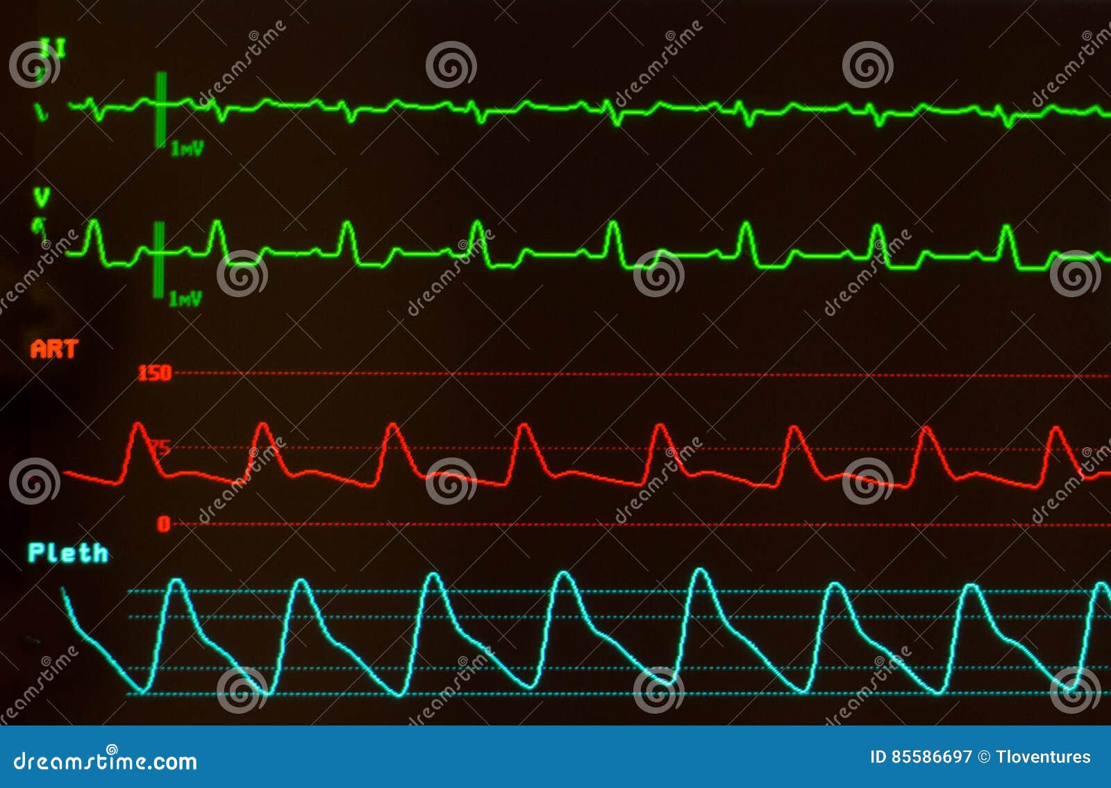 Heart Monitor With Intraventricular Conduction Delay On EKG Royalty ... Heart Monitor With Intraventricular Conduction Delay On EKG Royalty ...
