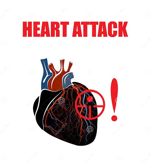 Heart Myocardial Infarction Stock Vector Illustration Of Attack