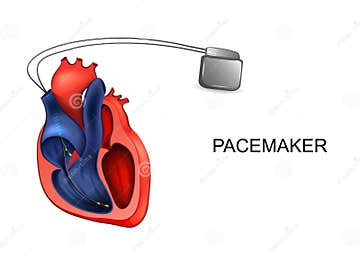 Heart and Pacemaker. Cardiology Stock Vector - Illustration of aortic ...