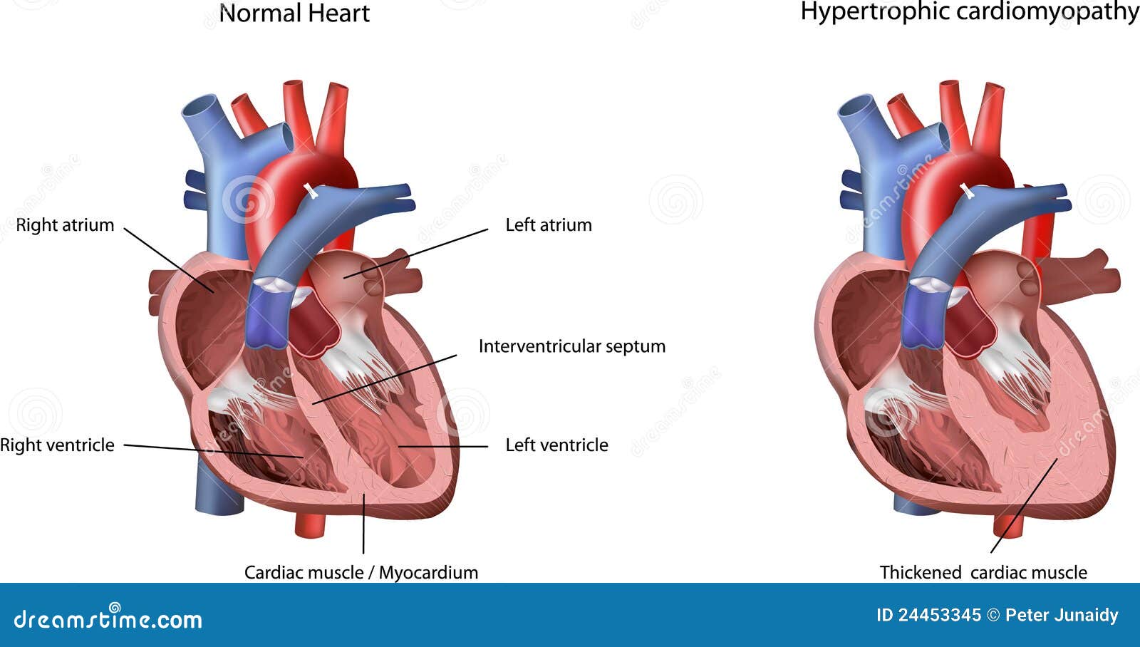 Heart Problem Hypertrophic Cardiomyopathy Stock Vector - Illustration ...