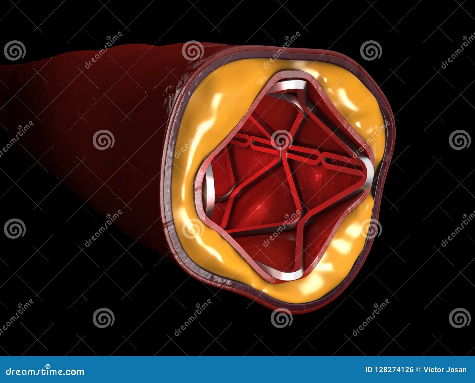 The In Heart Catheterization Through The Radial Artery, The Cath Stock ...