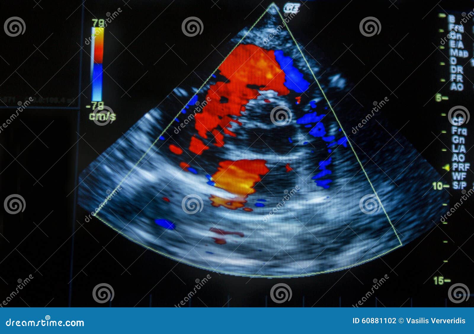 Heart Ultrasound Image on a Computer Screen. Stock Photo - Image of ...