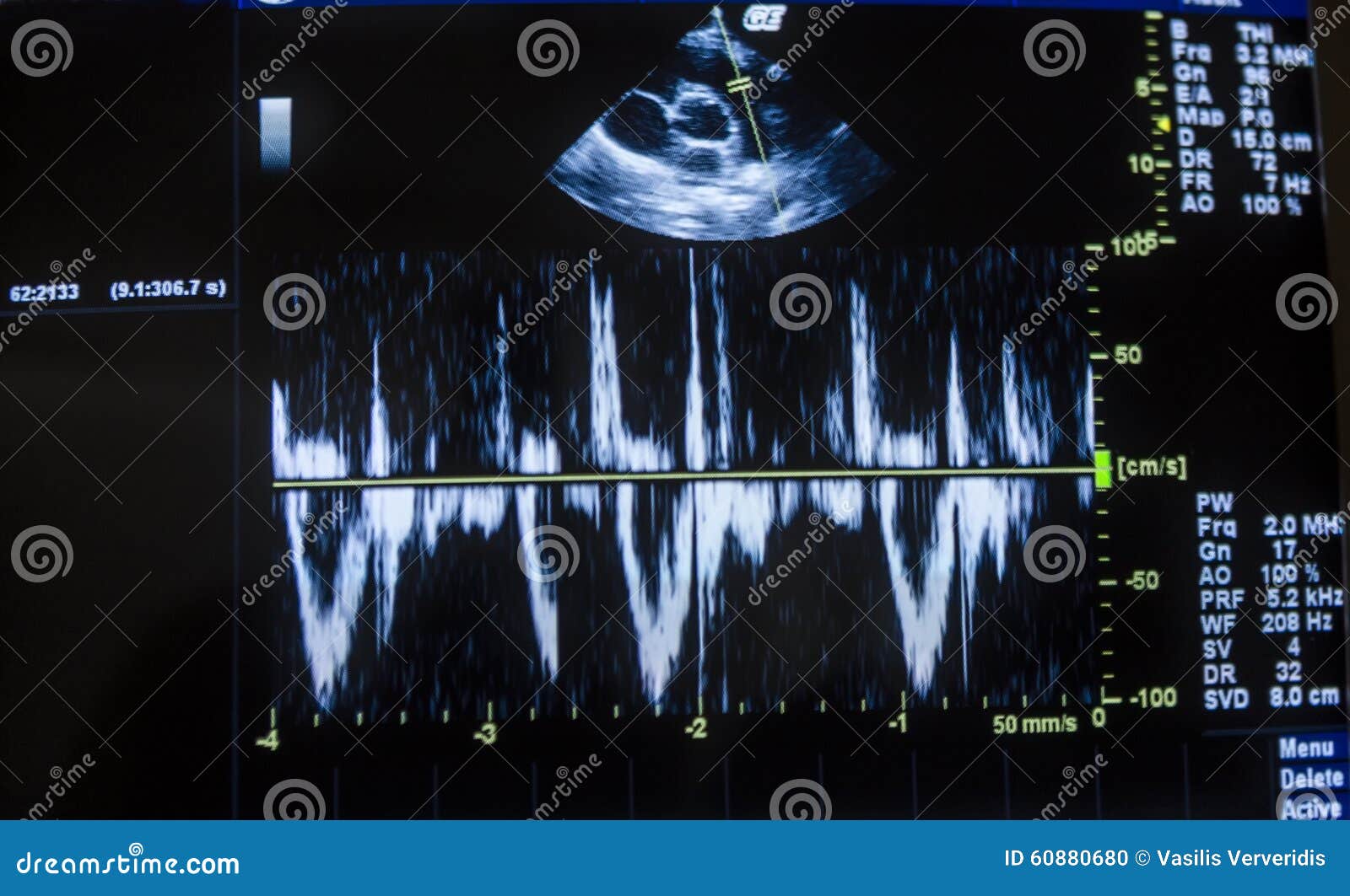 Heart Ultrasound Image on Computer Screen and Cardiogram. Stock Photo ...