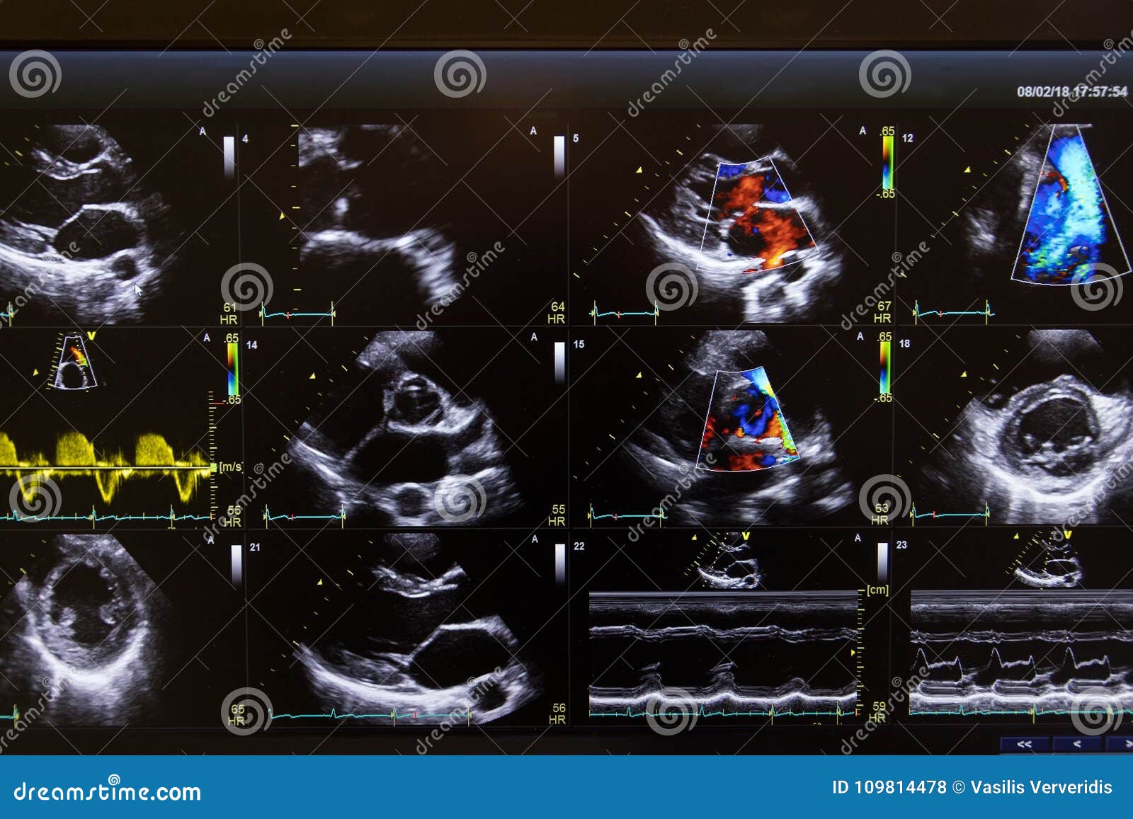 Heart ultrasound image stock photo. Image of treatment - 109814478
