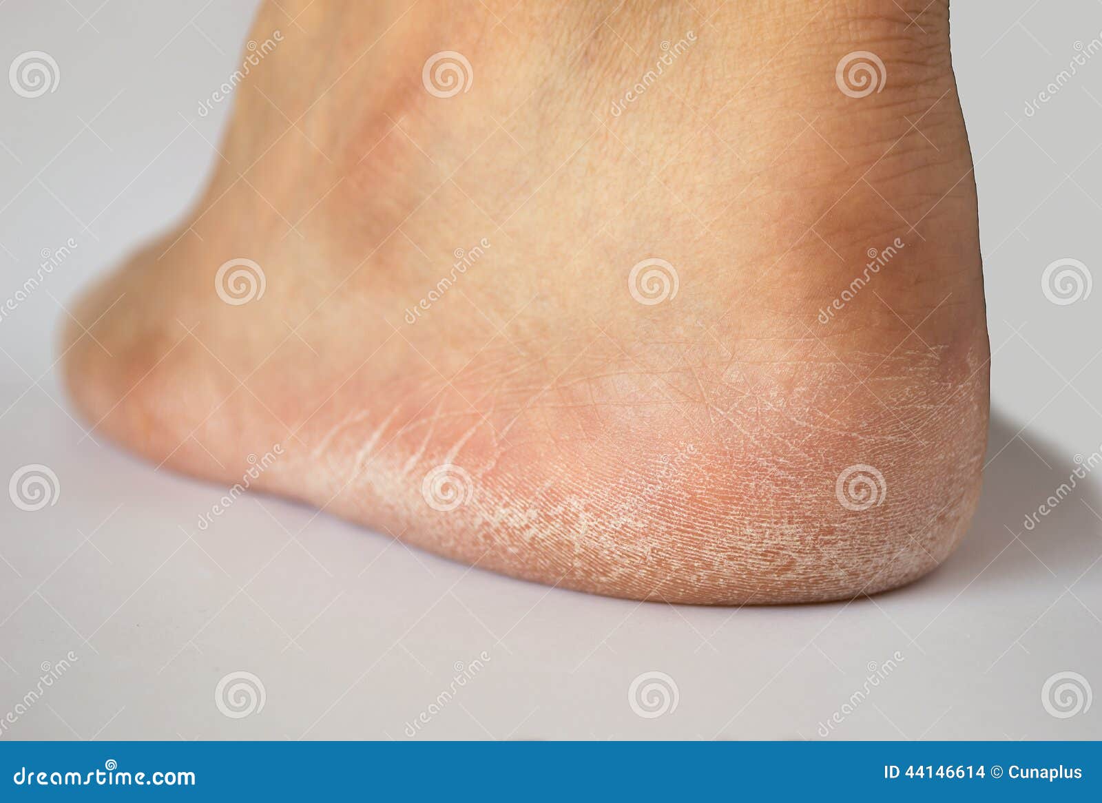 Heel cracked of foot stock photo. Image of foot, heat - 44146614
