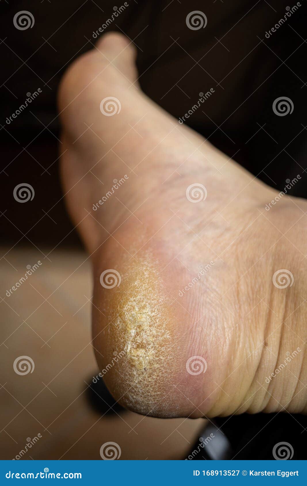 The Heel of One Foot is a Lot of Torn Cornea Stock Image - Image of ...