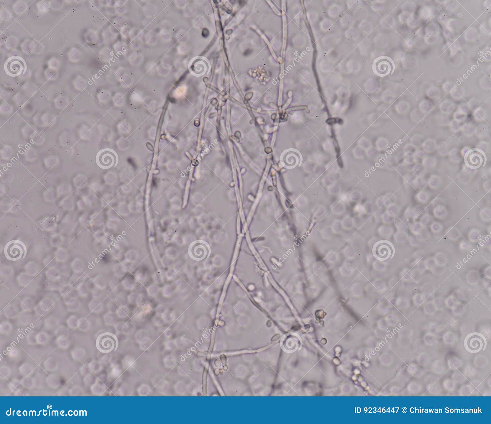 Hefezellen in Der Urinprobe Stockbild - Bild von krankheit, brauen ...