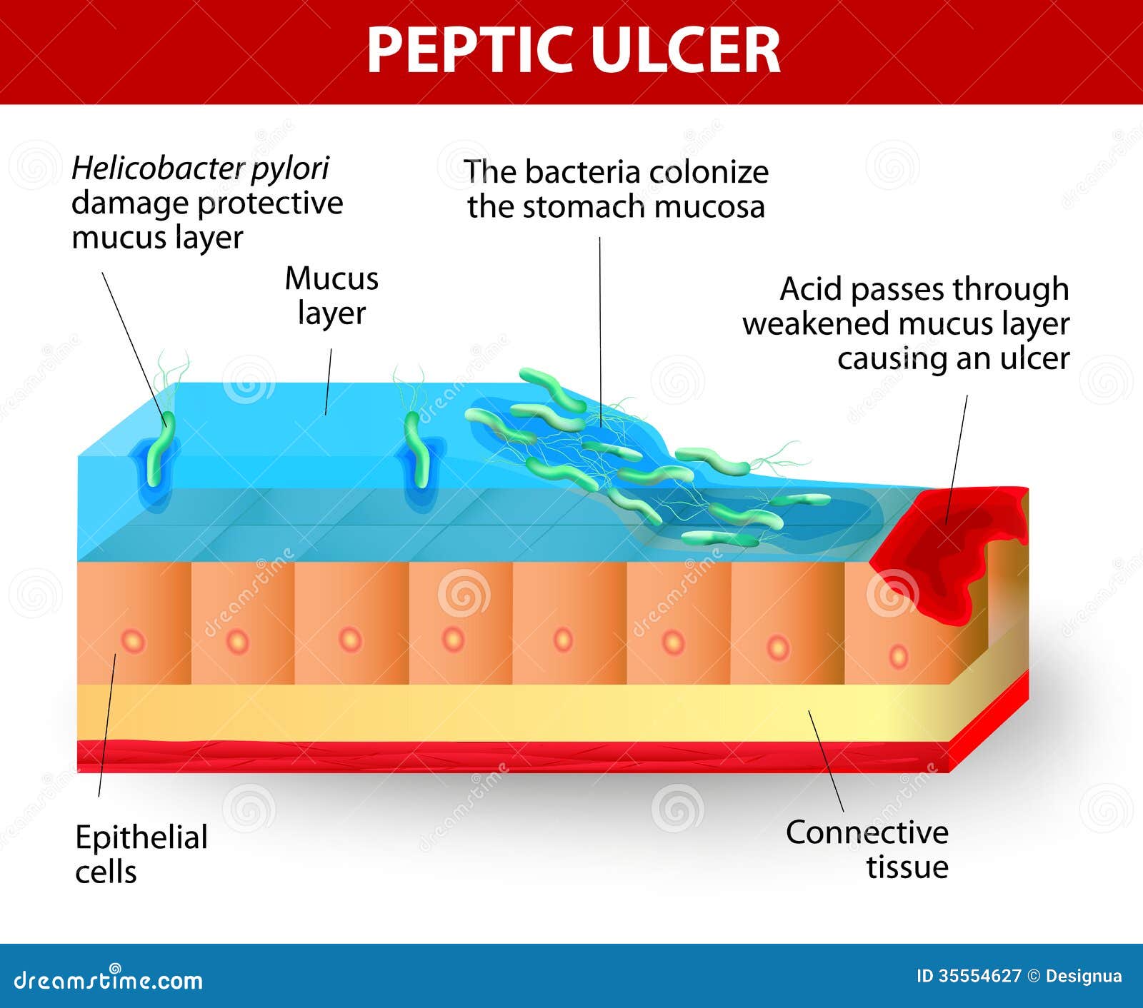 Helicobacter Pylori E Malattia Delle Ulcere Illustrazione Vettoriale ...