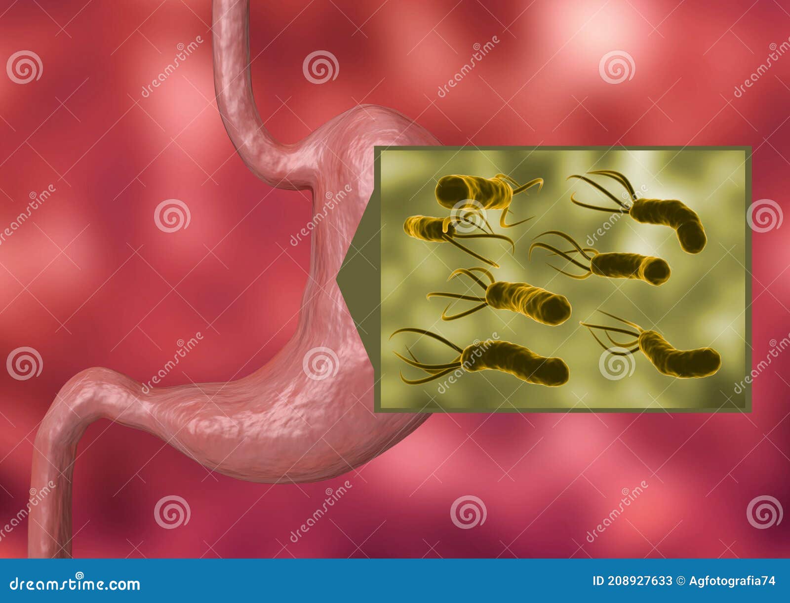 Helicobacter Pylori In The Microscopic Environment. Is A Bacterium That ...