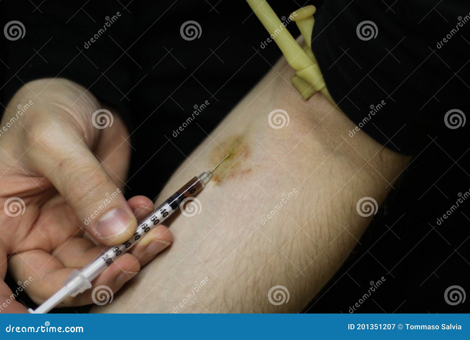 Hematoma En El Brazo De Un Publicista Adicto a La Cocaína Mientras ... Hematoma En El Brazo De Un Publicista Adicto a La Cocaína Mientras ...