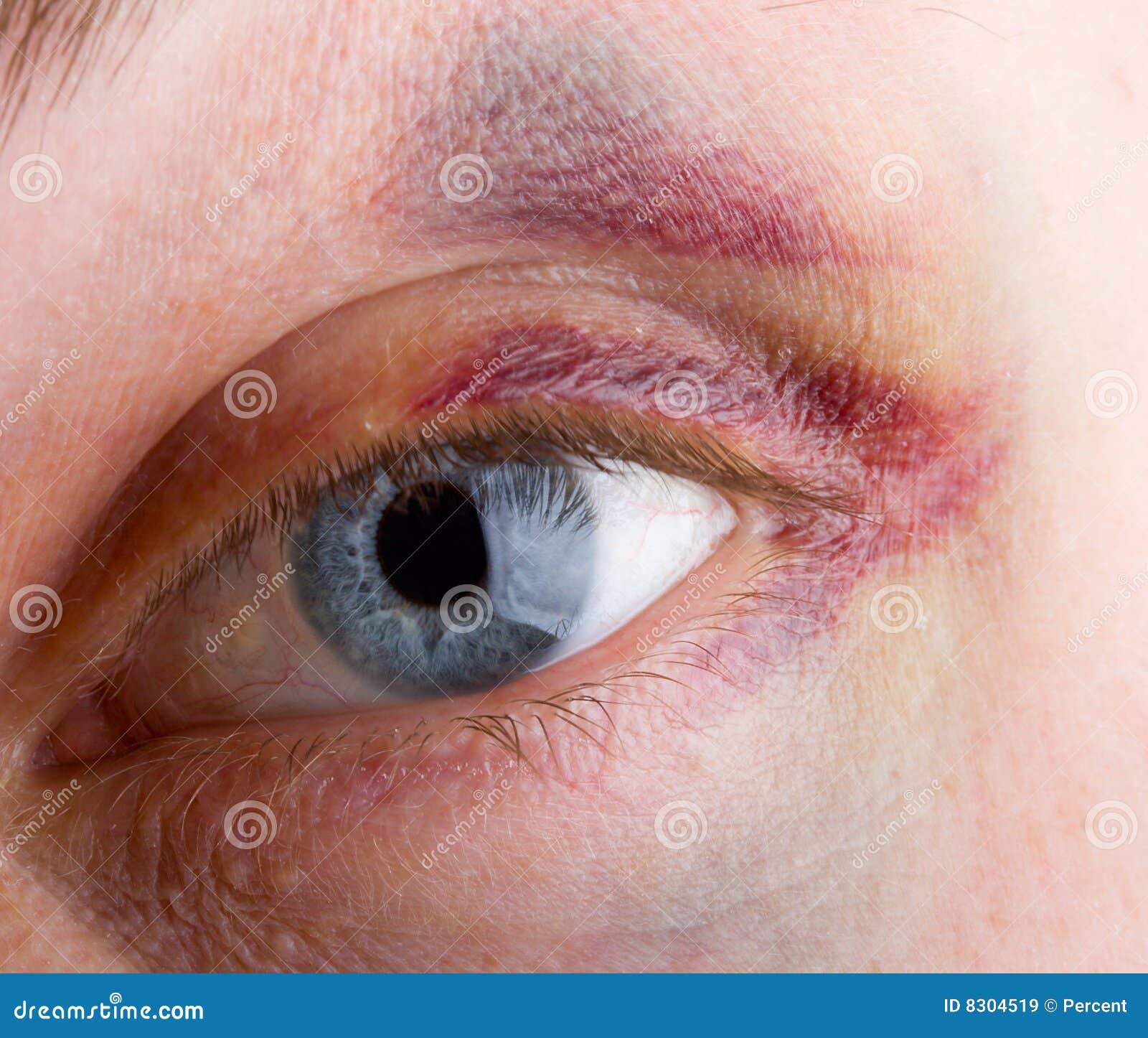 Hematoma en ojo imagen de archivo. Imagen de cierre, macro - 8304519