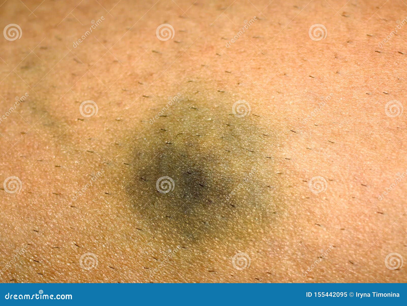 Hematoma Na Pele Equimose Após Ferimento Imagem de Stock - Imagem de ...