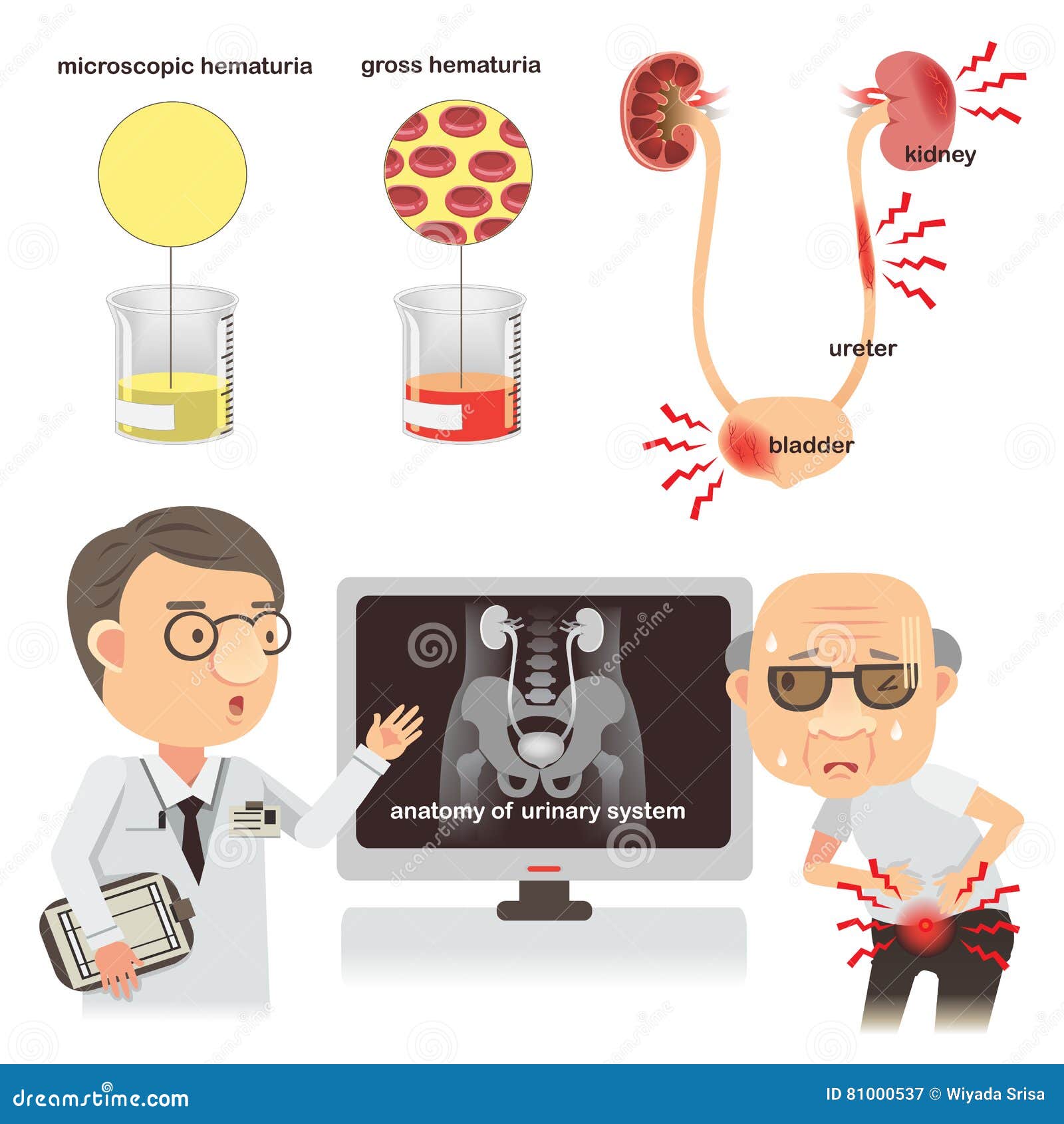 Hematuria ilustración del vector. Ilustración de infeccioso - 81000537