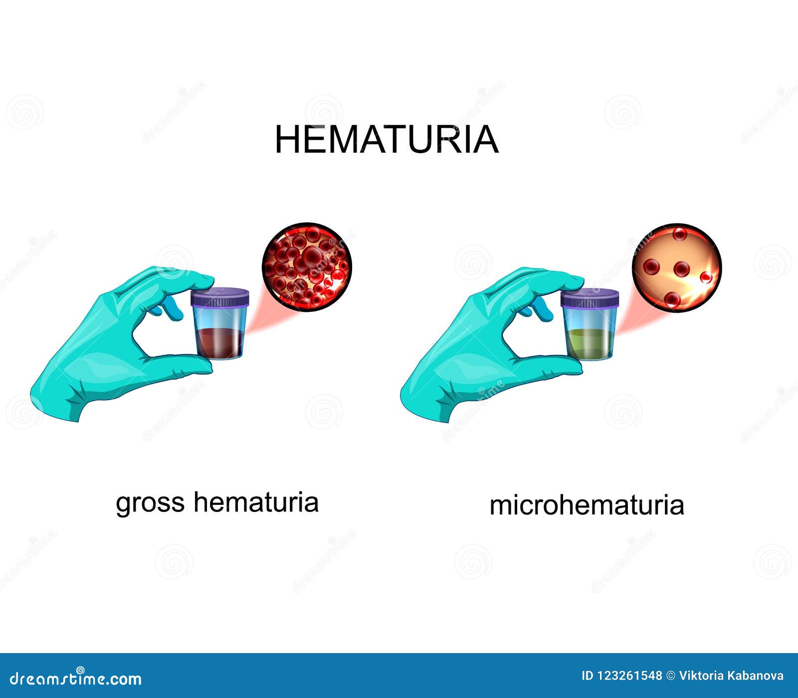 Hematuria Blut im Urin vektor abbildung. Illustration von lackieren ...