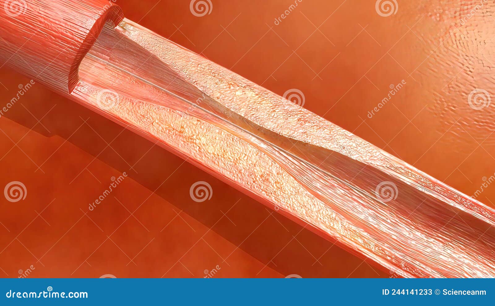 Hemoglobin Cells Flowing through a Blocked Artery Causing ...