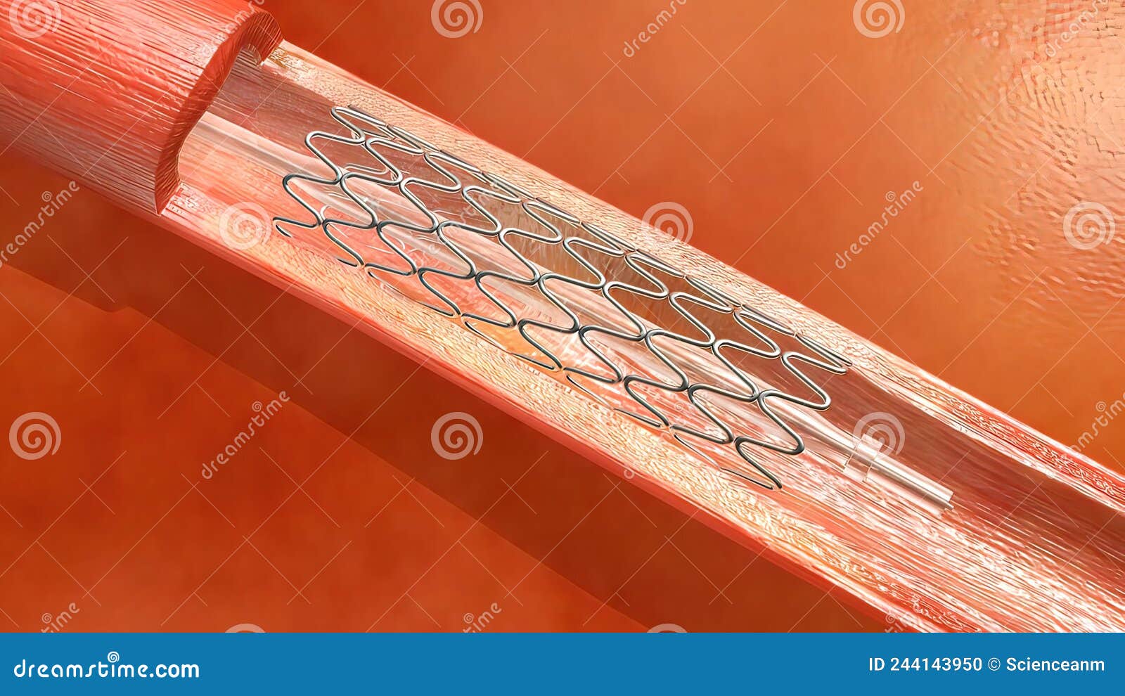 Hemoglobin Cells Flowing through a Blocked Artery Causing ...