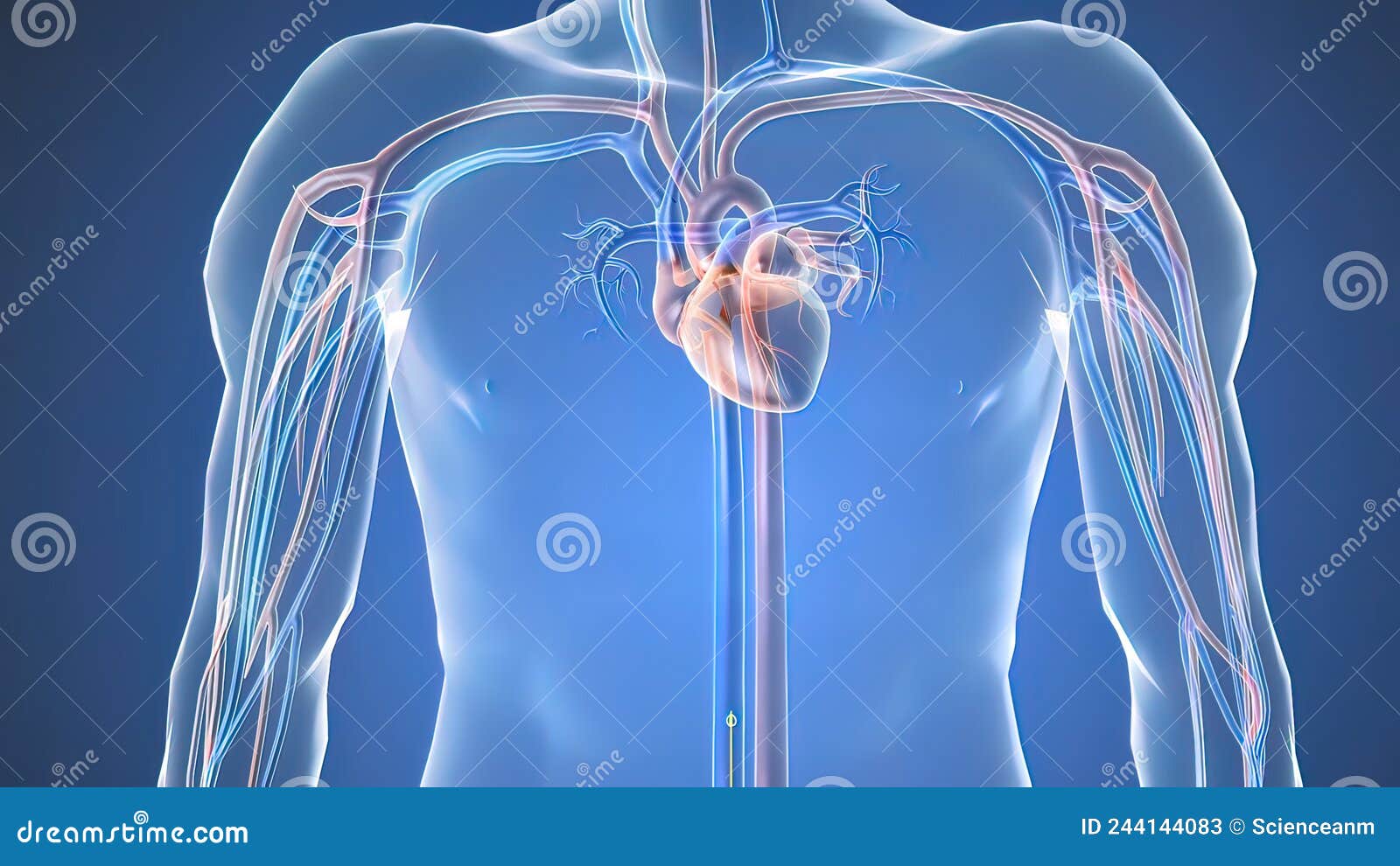 Opening the Occluded Artery by Inserting a Stent Stock Illustration ...