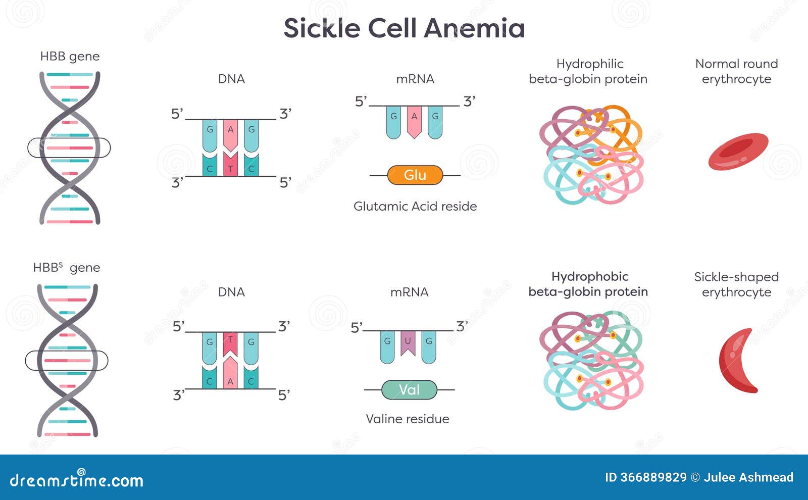 Sickle Cell Anemia HBB Point Mutation Graphic Cartoon Vector ...