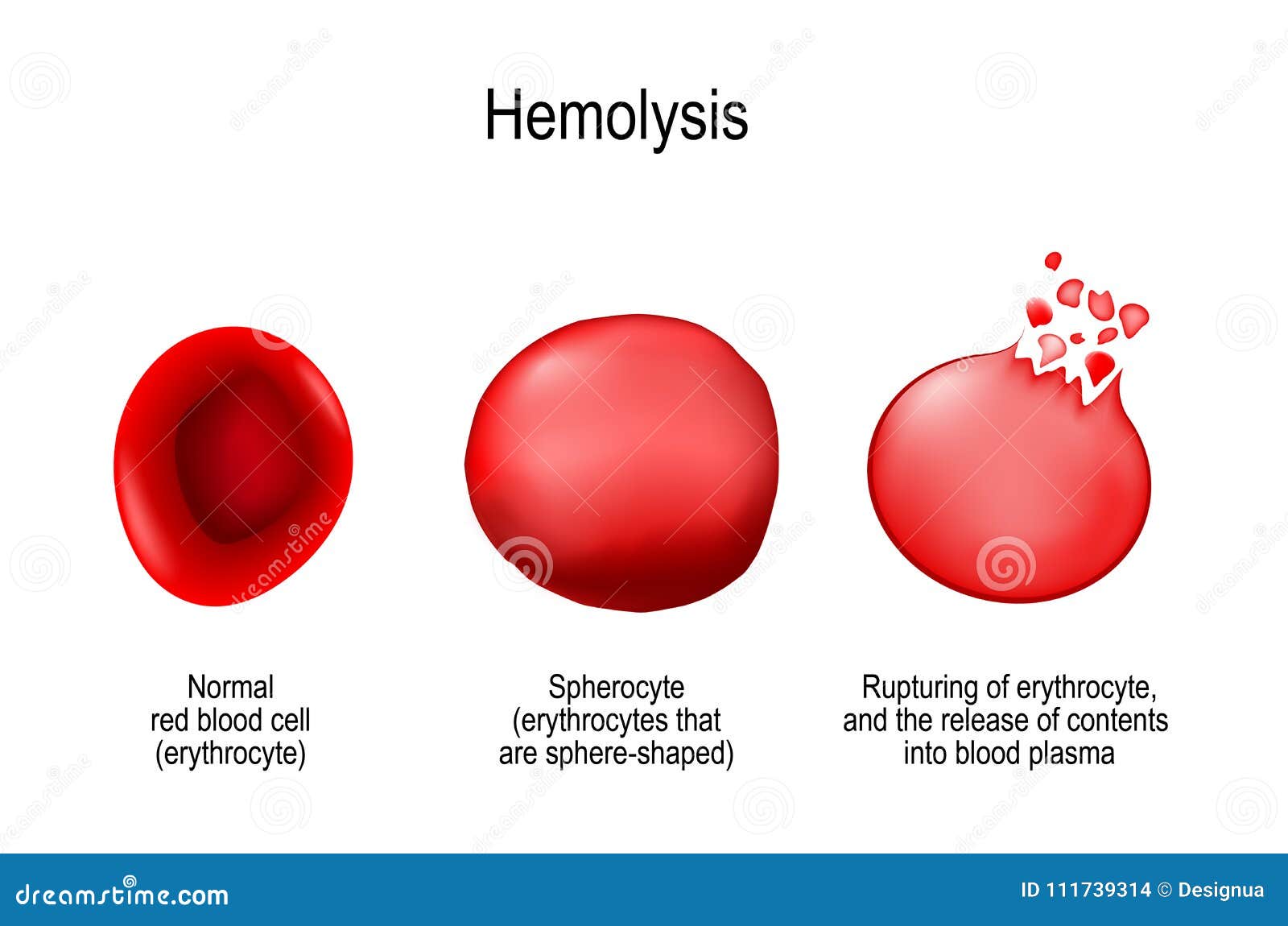 Hemolysis Globule Rouge, Spherocyte, Et Rupture Normaux D'e ...