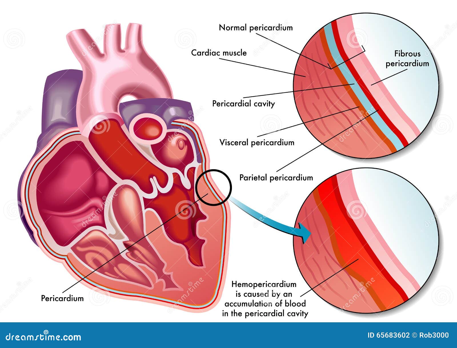 Pericardial Cartoons, Illustrations & Vector Stock Images - 65 Pictures ...